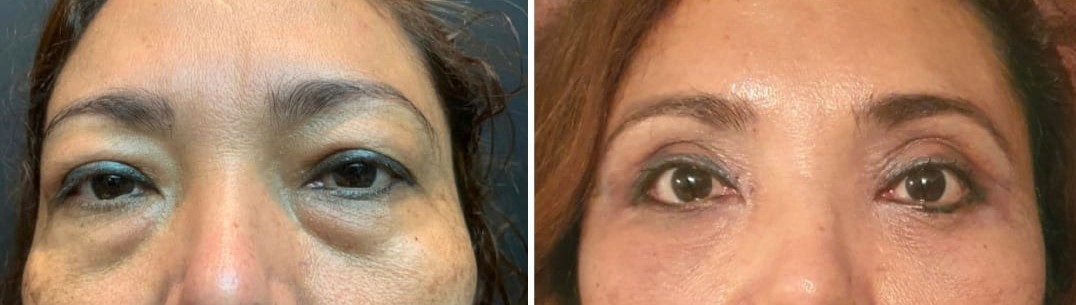 Blepharoplasty: The Ultimate Solution for Beautiful Eyes